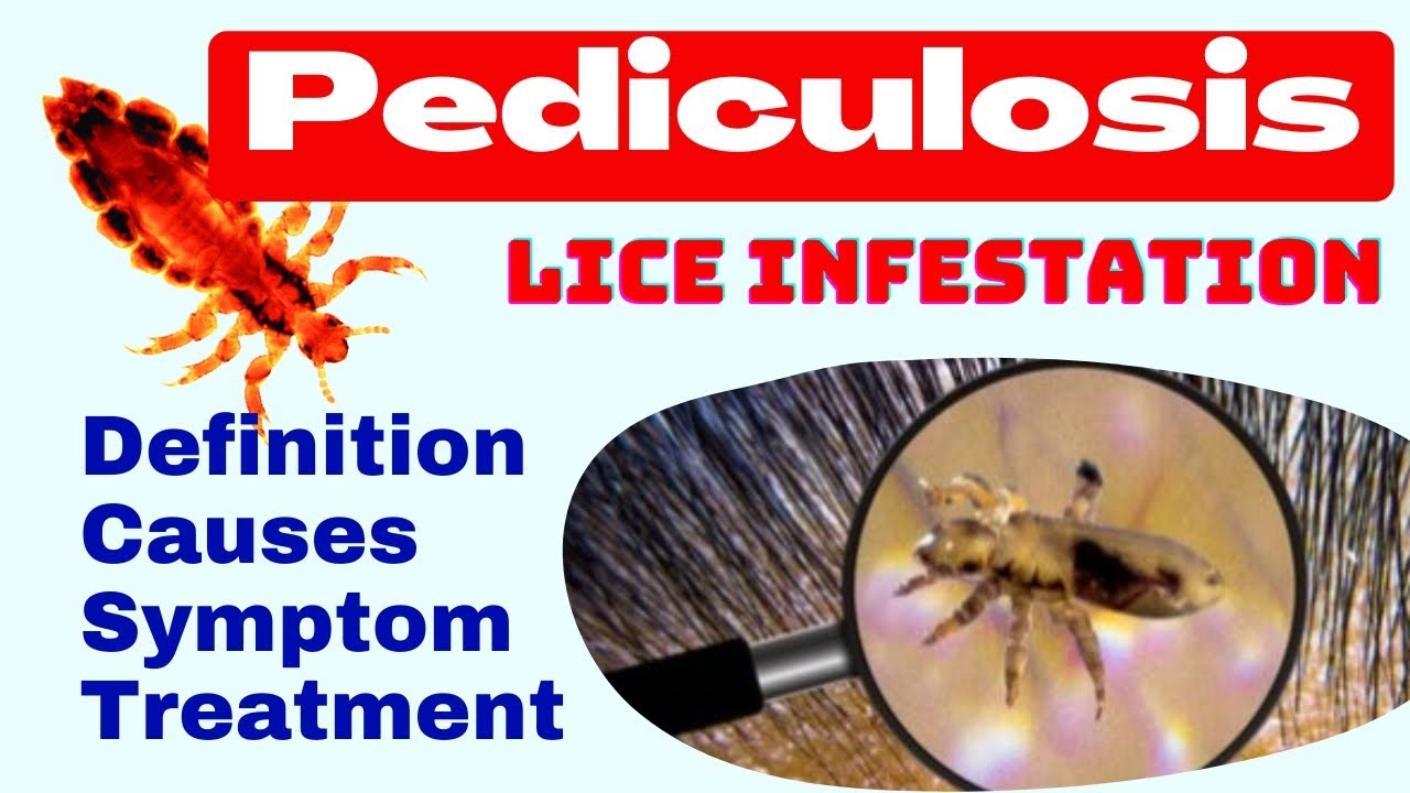 Pediculosis Definition Cause Symptoms Treatment Lice Treatment