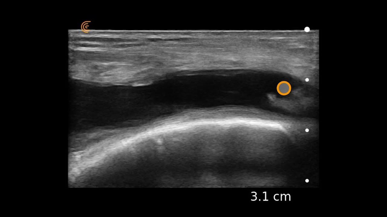 Knee Effusion - Clarius Mobile Health Knee Effusion - Clarius Mobile Health