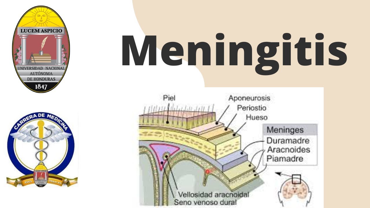 SIGNOS DE LA MENINGITIS - YouTube