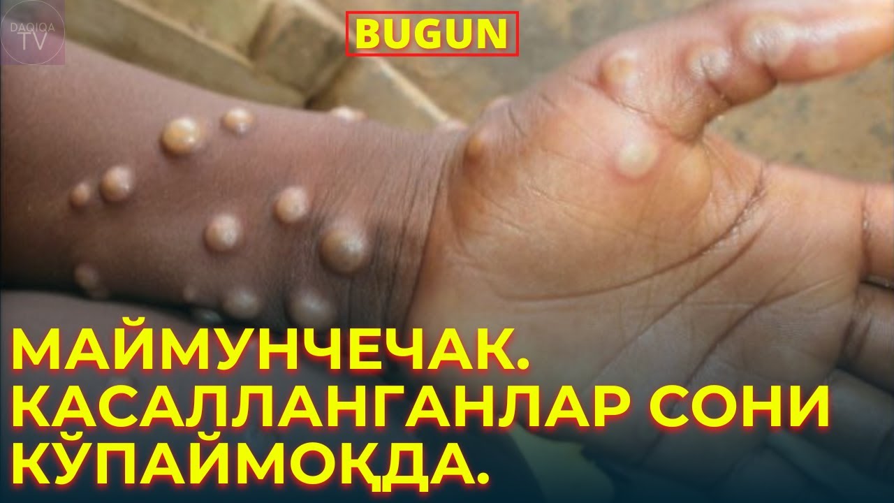 Maymun chechak xaqida. Kasallanganlar soni ortmoqda. info - YouTube