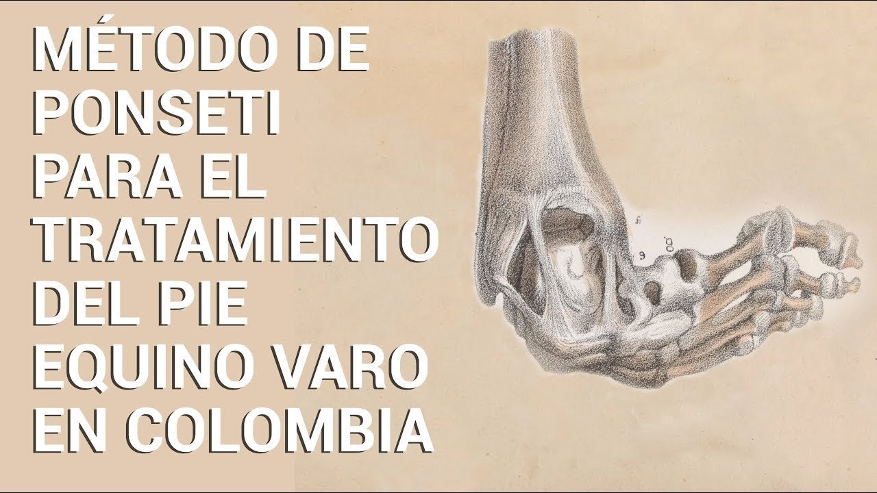 Tratamiento Método Ponseti Colombia - Rotary International - YouTube