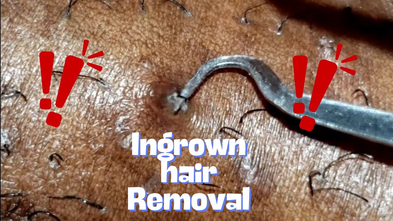 Ingrown hair removal compilation! Huge ingrown hairs. - YouTube