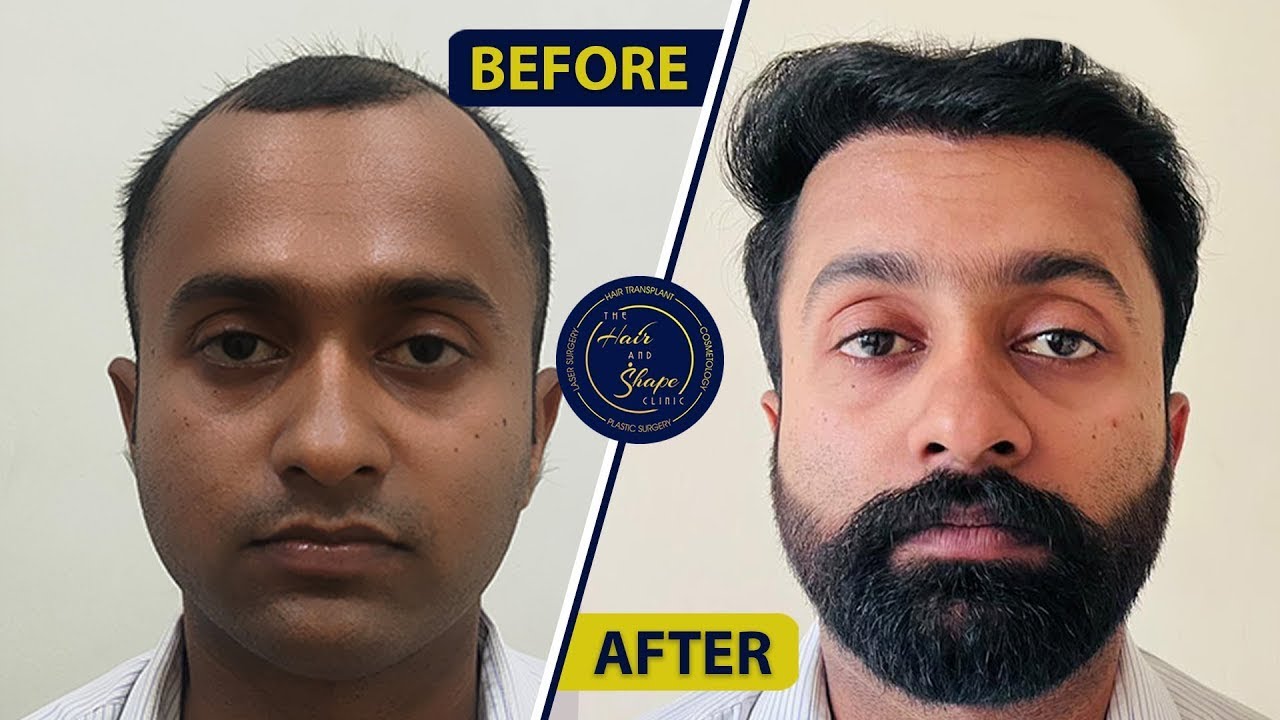 Amazing Hair Transplant Transformation: Before and After Results ...