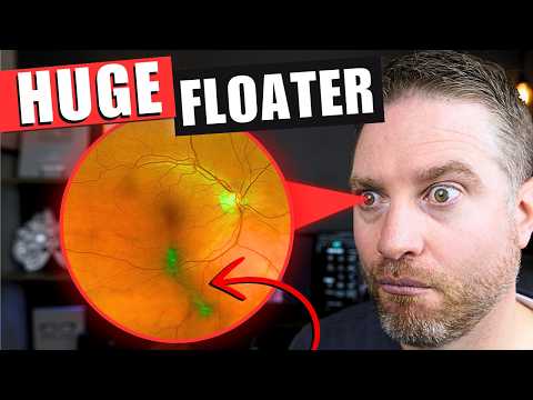 What Causes This Huge Eye Floater!? PVD Treatments Explained