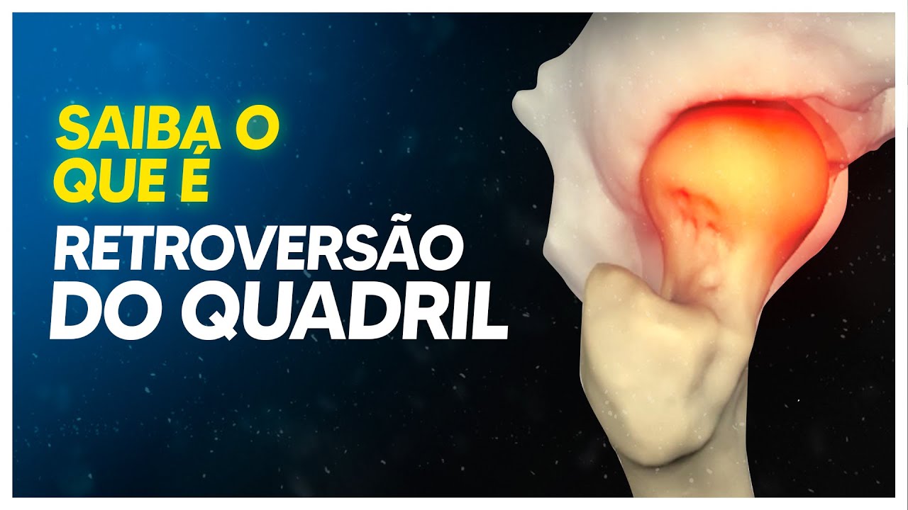 O QUE É E COMO ACONTECE A RETROVERSÃO FEMORAL NO QUADRIL? - YouTube