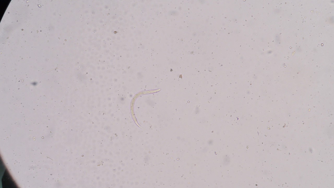 Strongyloides stercoralis (threadworm) in stool, analyze by microscope ...