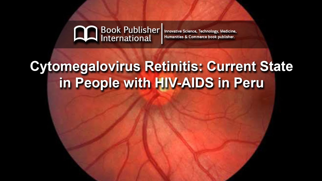 Cytomegalovirus Retinitis: Current State in People with HIV-AIDS in ...