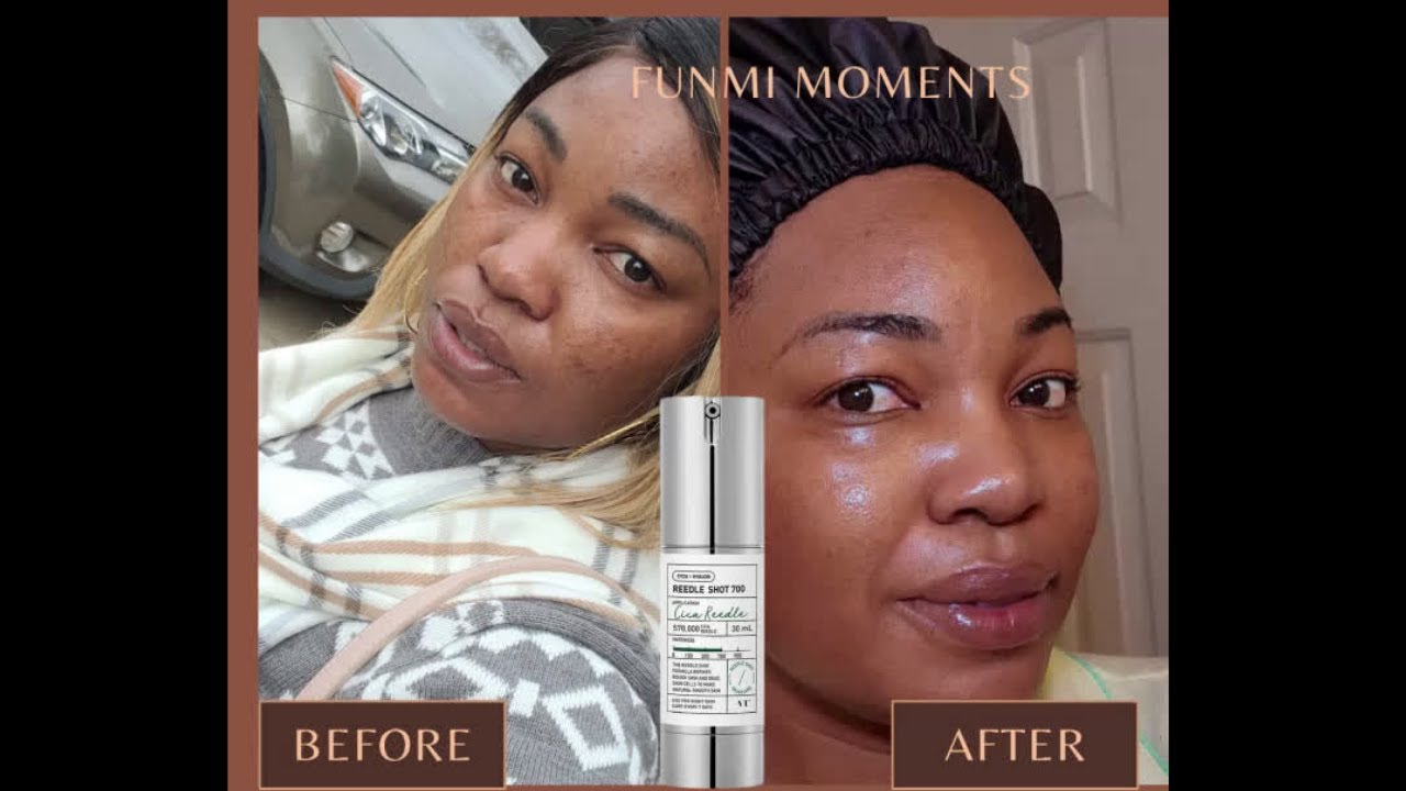 Unlocking Radiance: VT REEDLE SHOT Review on Melanin & Black Skin! 🌟🌟 ...