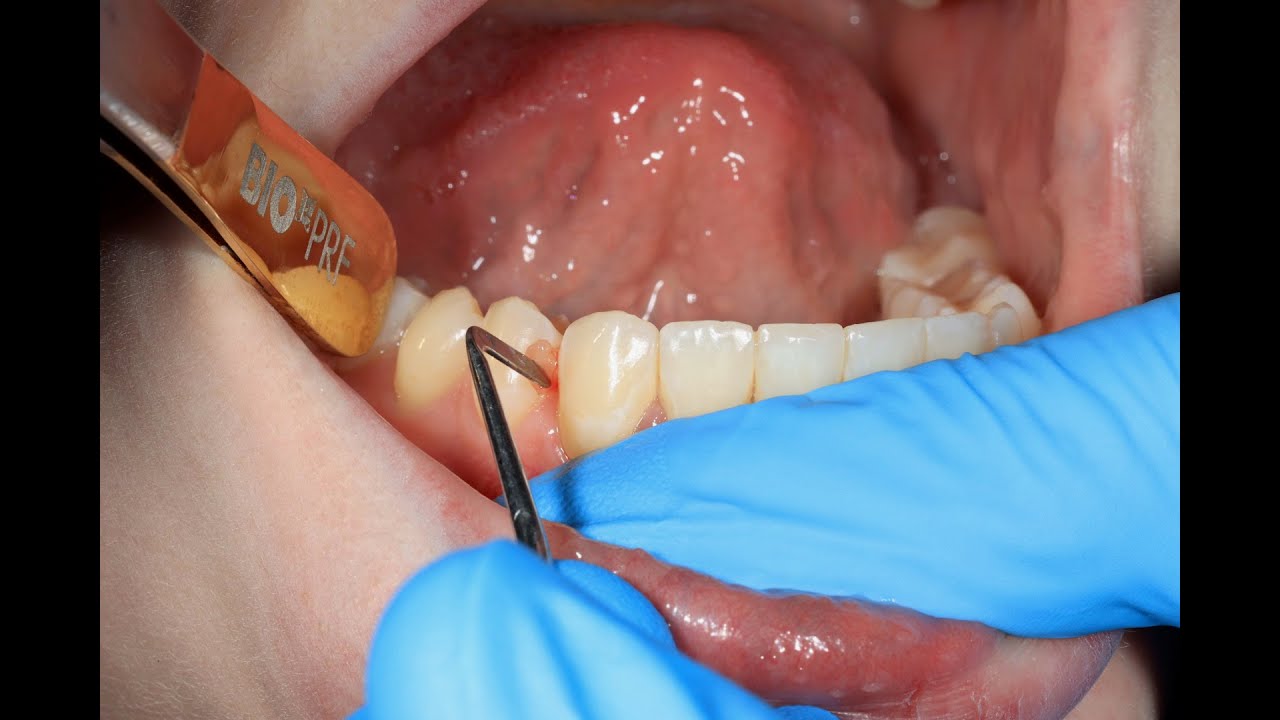Gum Disease: New Treatment Using LASERS & PRF - YouTube