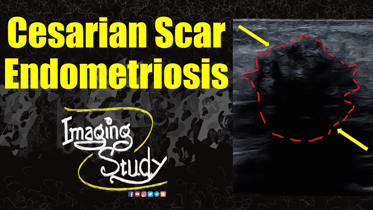 Cesarian Scar Endometriosis || Ultrasound || Case 362 - YouTube