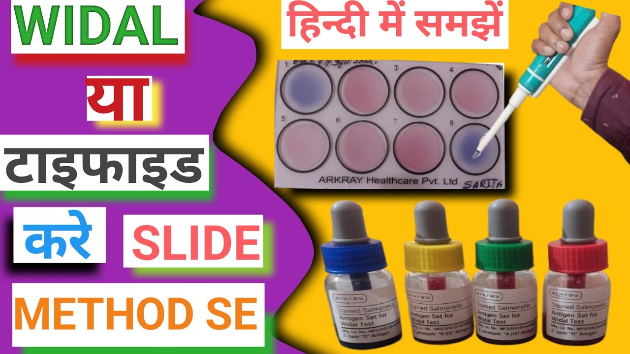 Widal test ! Typhoid test!serology Typhoid slide method se kaise kare ...
