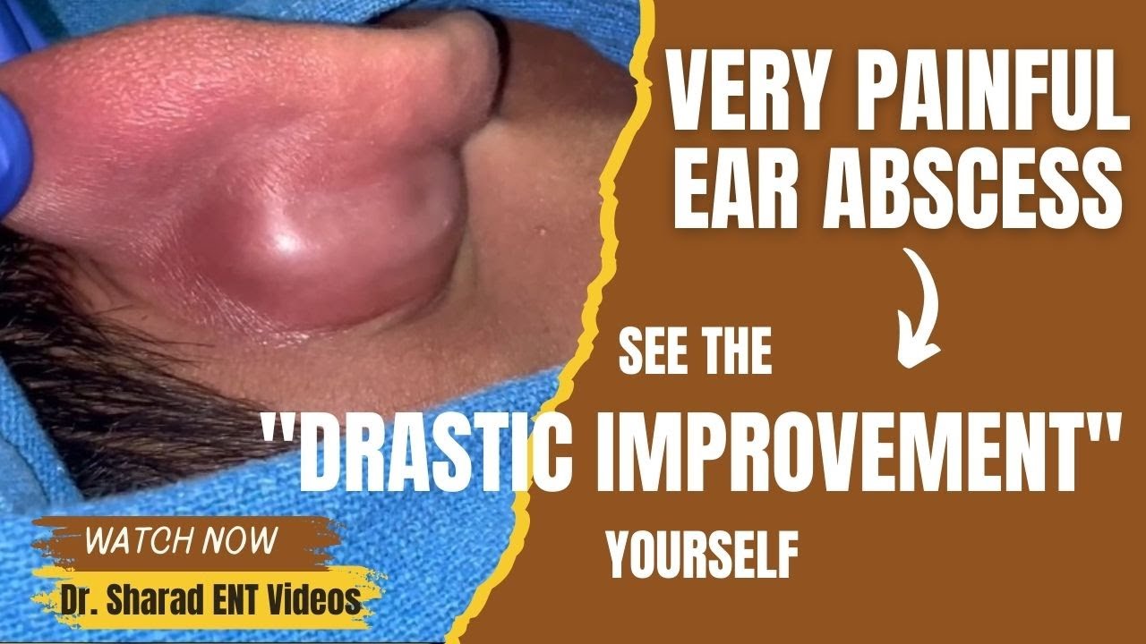 ABSCESS BEHIND THE EAR || An immediate improvement after pus aspiration ...