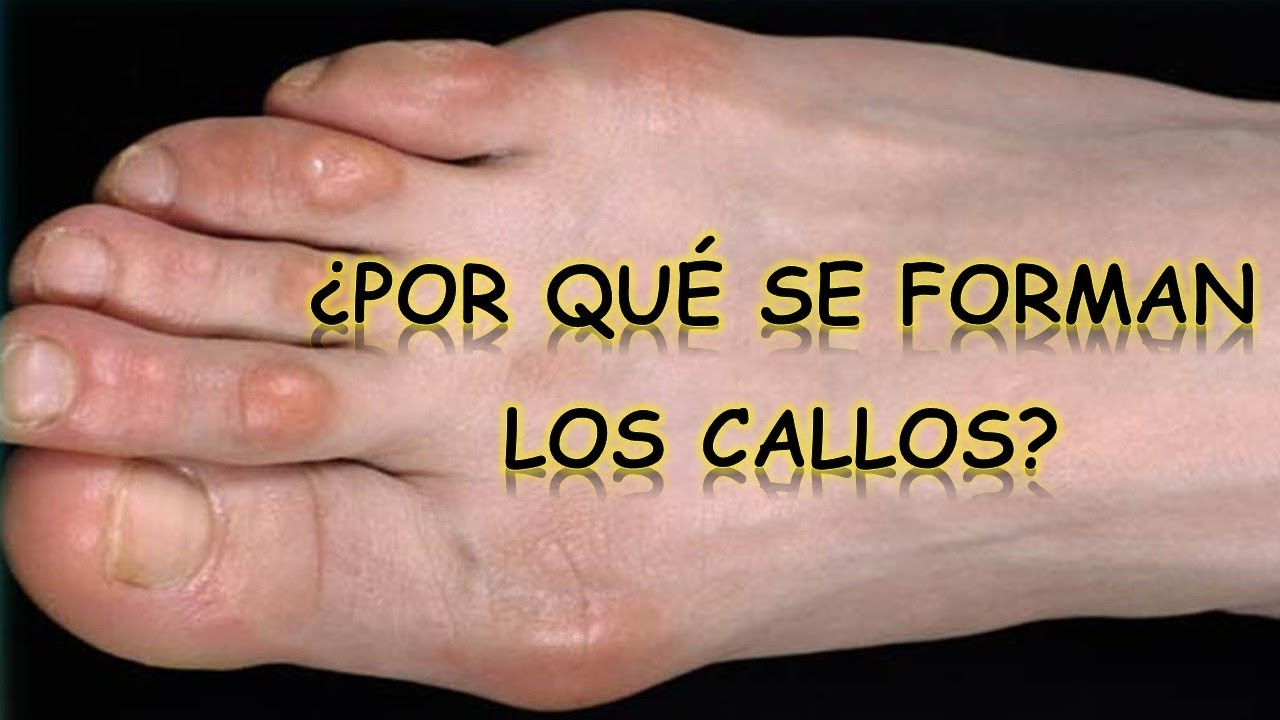 ¿POR QUE SE FORMAN LOS CALLOS? | CurioCiencia - YouTube