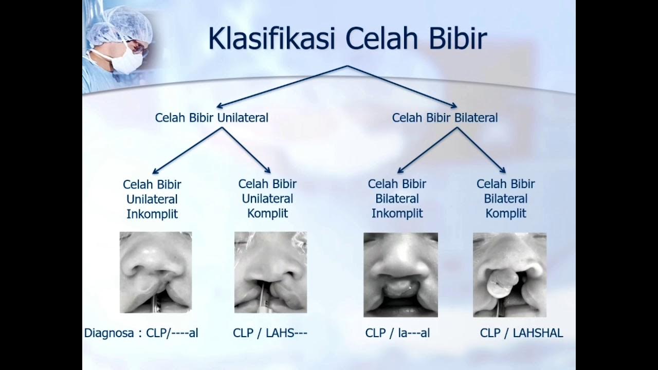Kuliah edukasi celah bibir dan langit langit (bibir sumbing dan sumbing langit-langit) - YouTube