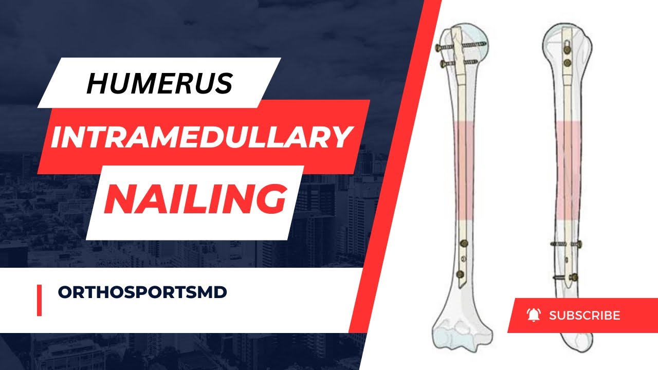 Humerus intramedullary nailing | Pathologic fracture | ORIF IM Nailing ...