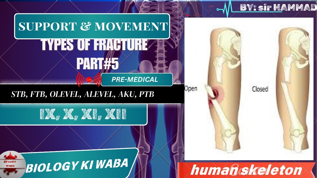 Type Of Fracture || Support And Movement || Biology || Class XII - YouTube