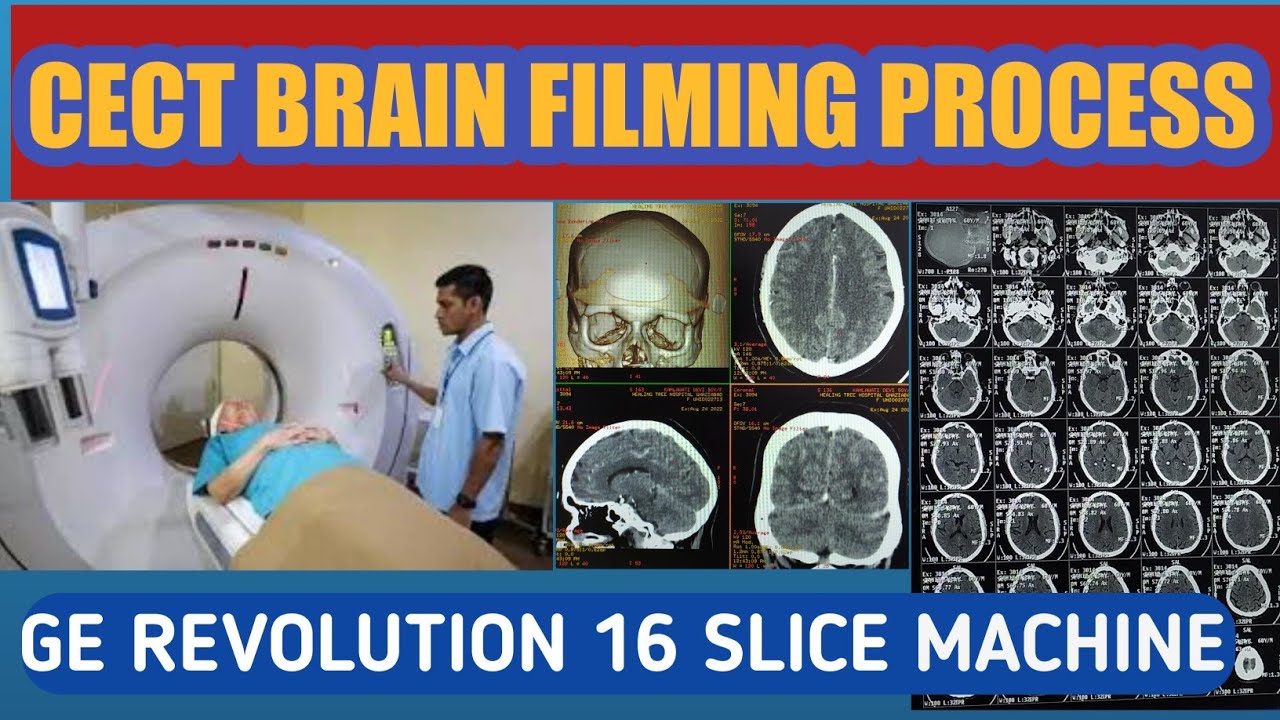 CECT BRAIN FILMING PROCESS #CT HEAD CONTRAST FILMING METHOD #CECT HEAD ...