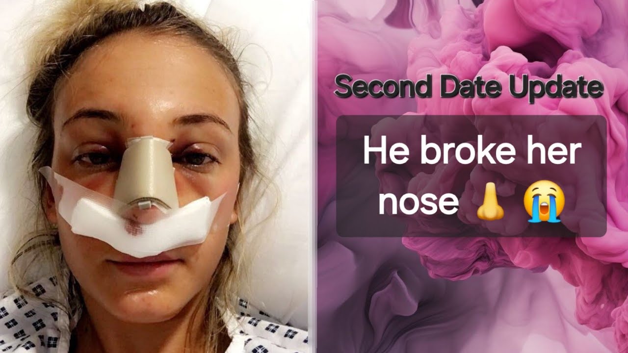 Episode 143 of the Second Date Update. He broke her nose 👃 - YouTube