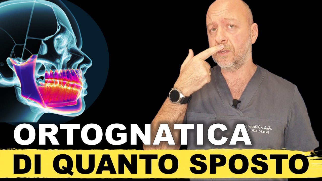 Di quanto spostare i mascellari nell'intervento maxillo facciale di ...