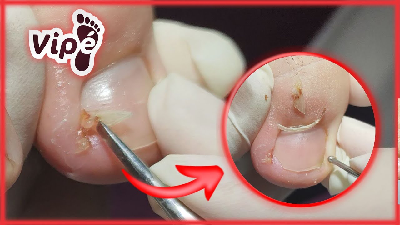OVERGROWN INFECTED INGROWN TOENAIL REMOVAL (PODOLOGIA EM UNHA ENCRAVADA ...