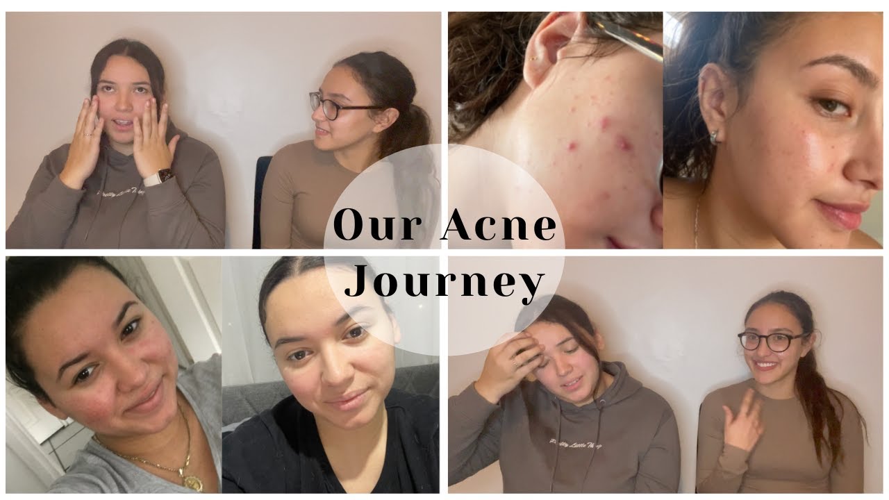 Our Acne Journey | Sarah and Loren - YouTube