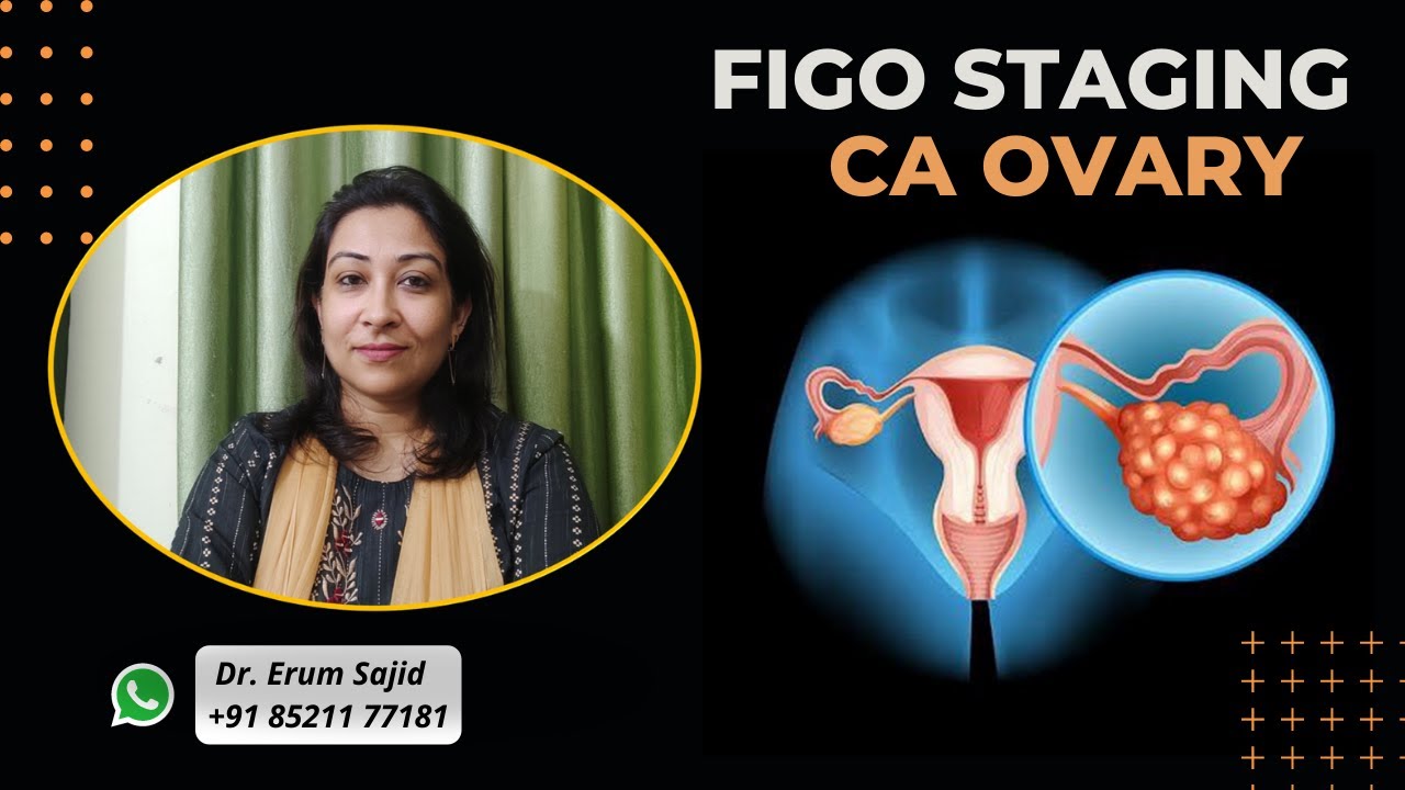 FIGO Staging CA Ovary | DNB Theory Class | DNB OBGYN coaching All India ...