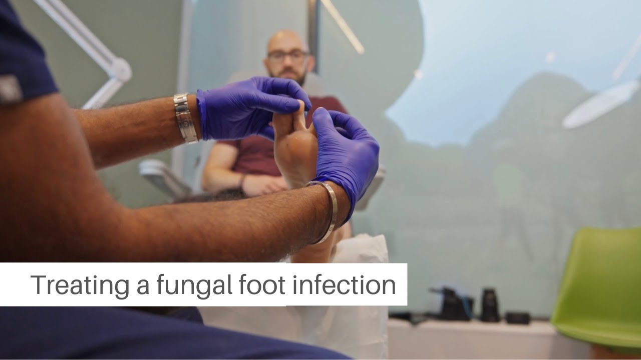 Flawless Feet foot and nail fungal infection advice - YouTube