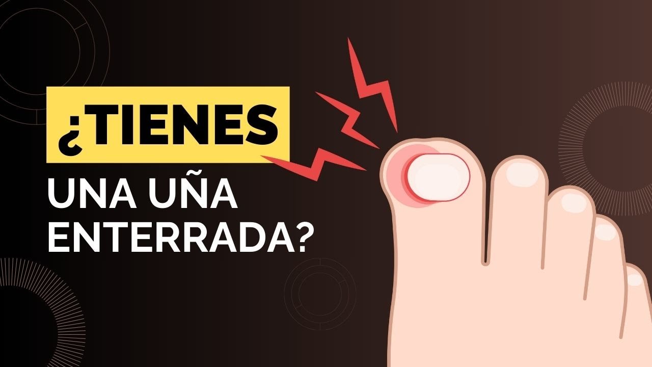 ¿Tienes una uña enterrada? Qué hacer (y qué NO hacer) 🦶 - YouTube