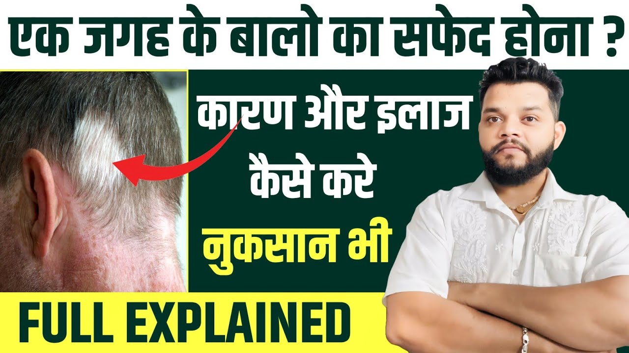 एक जगह के बालों का साफेद होने का कारण और इलाज | White Forelock Causes ...