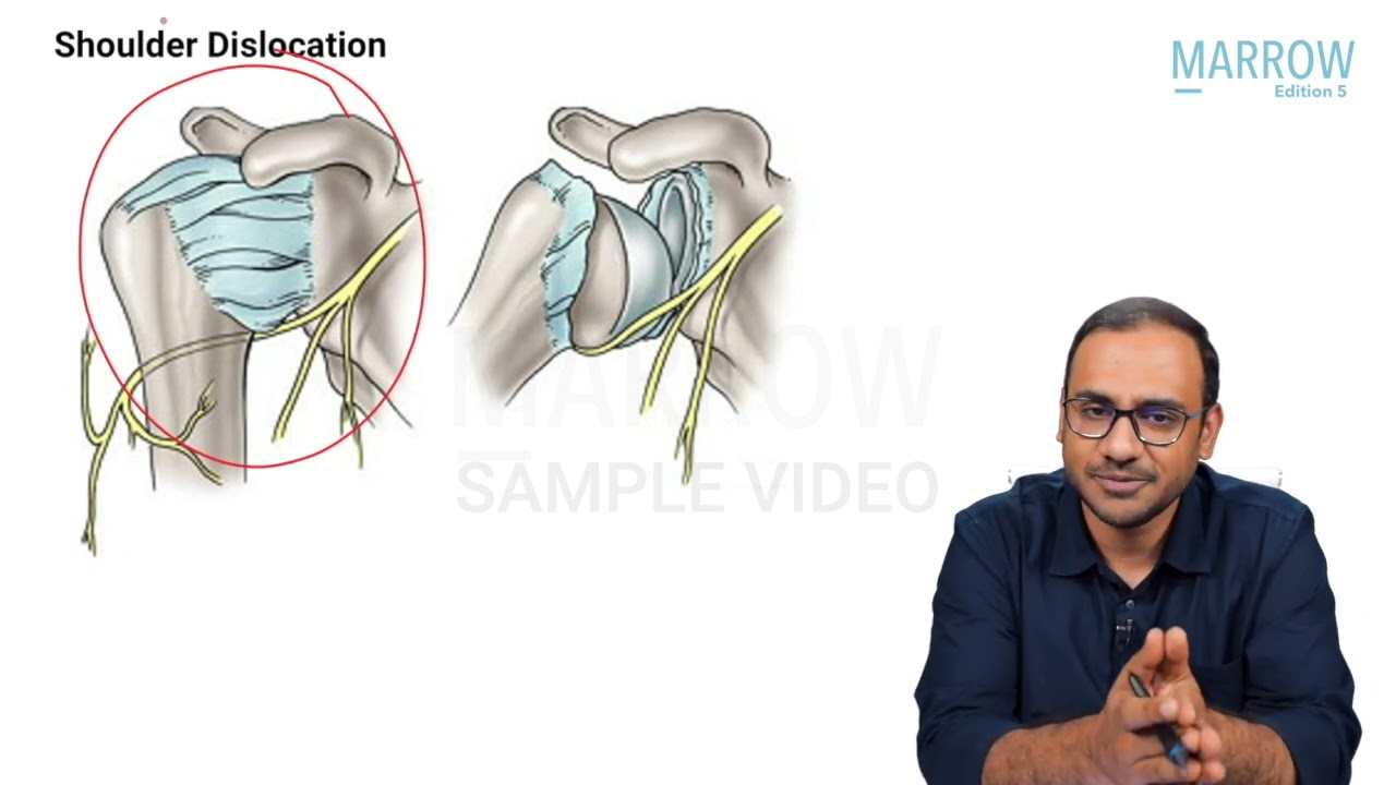 Orthopaedics : Anterior dislocation of shoulder - Marrow Edition 5 ...