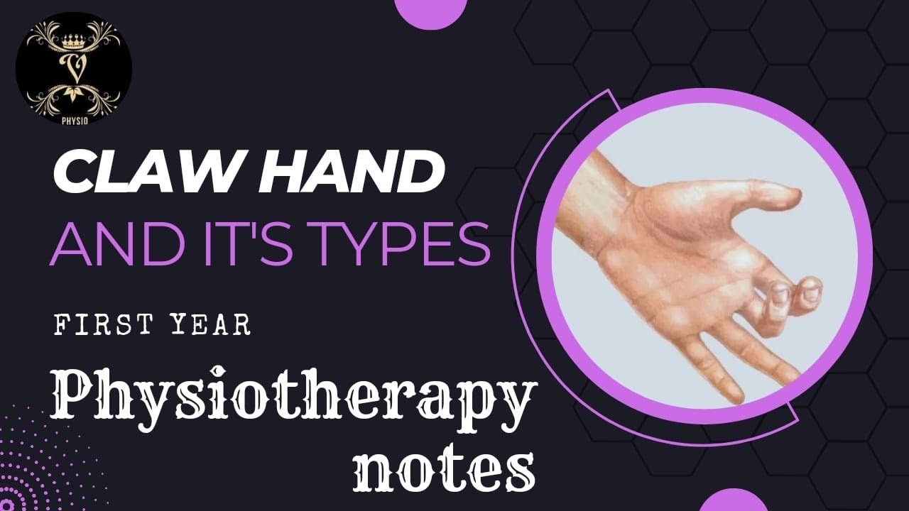 claw hand @VPhysio2k22 - YouTube