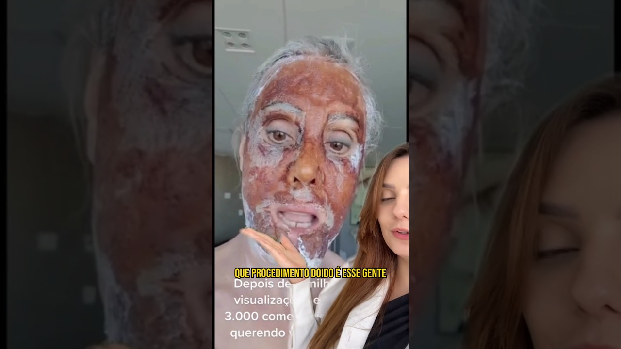 Que procedimento é esse? Peeling de fenol profundo saiba mais # ...