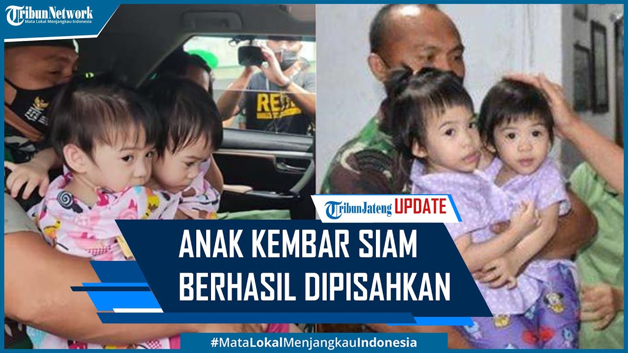 Anak Kembar Siam Prajurit TNI AD Berhasil Dipisahkan dalam Operasi 9 ...