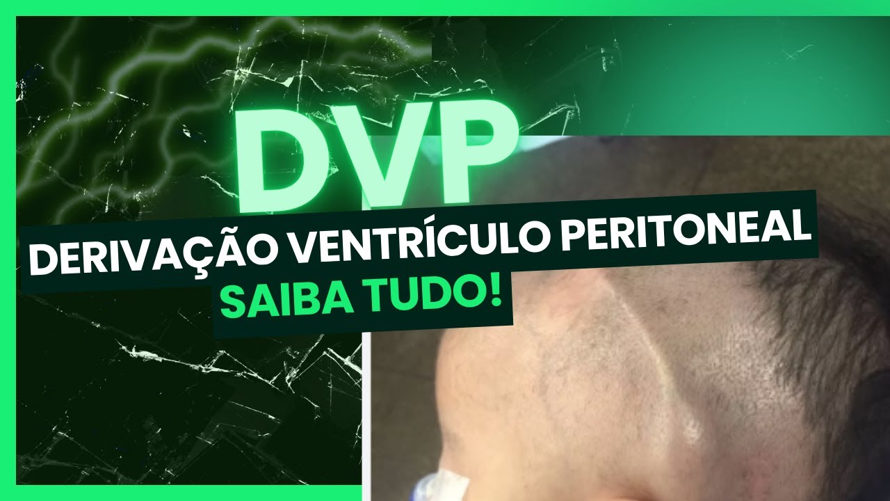 🎥 DVP - Derivação Ventrículo-Peritoneal: O Que É, Quando é Indicada e ...