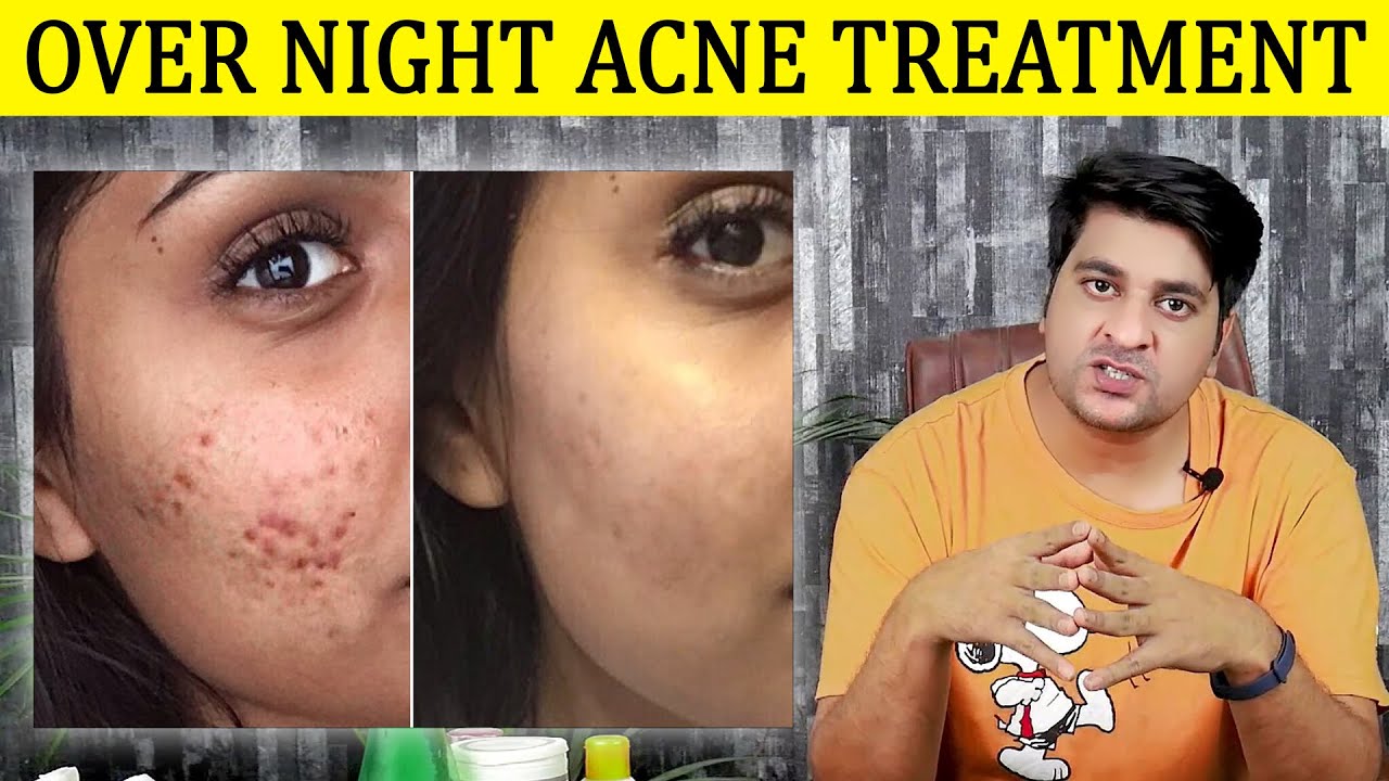 How To Remove Pimples Overnight Acne Treatment Hindi Urdu Youtube