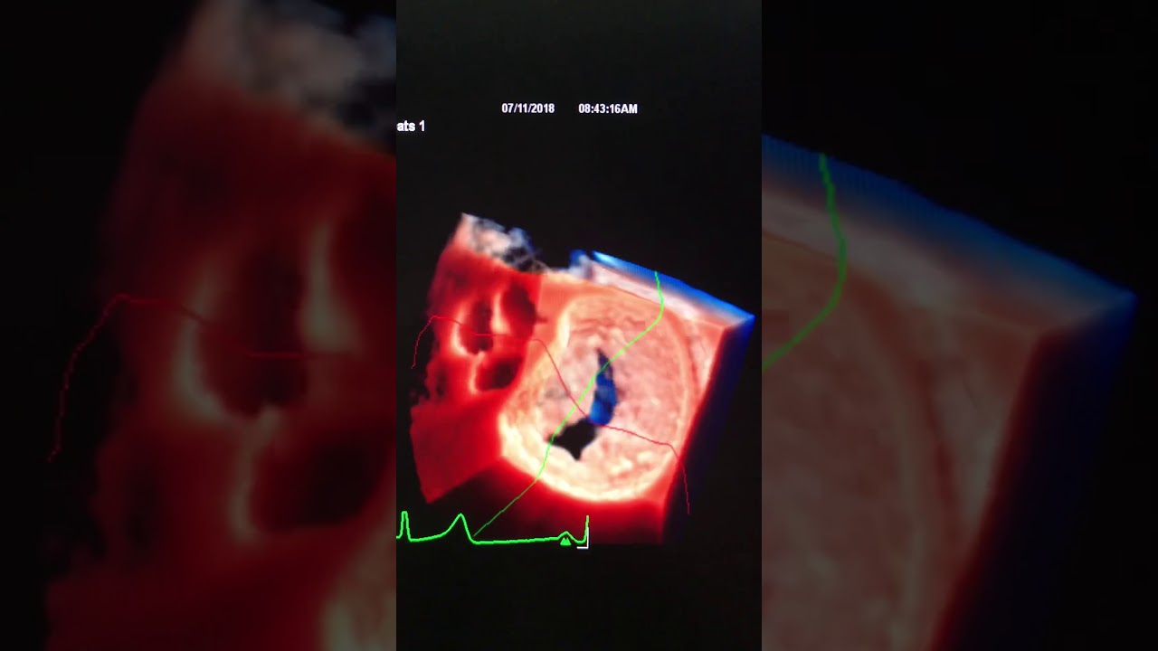 3D TrueVue Mitral Valve & Tricuspid Valve with USG PHILIPS - EPIQ CVx ...