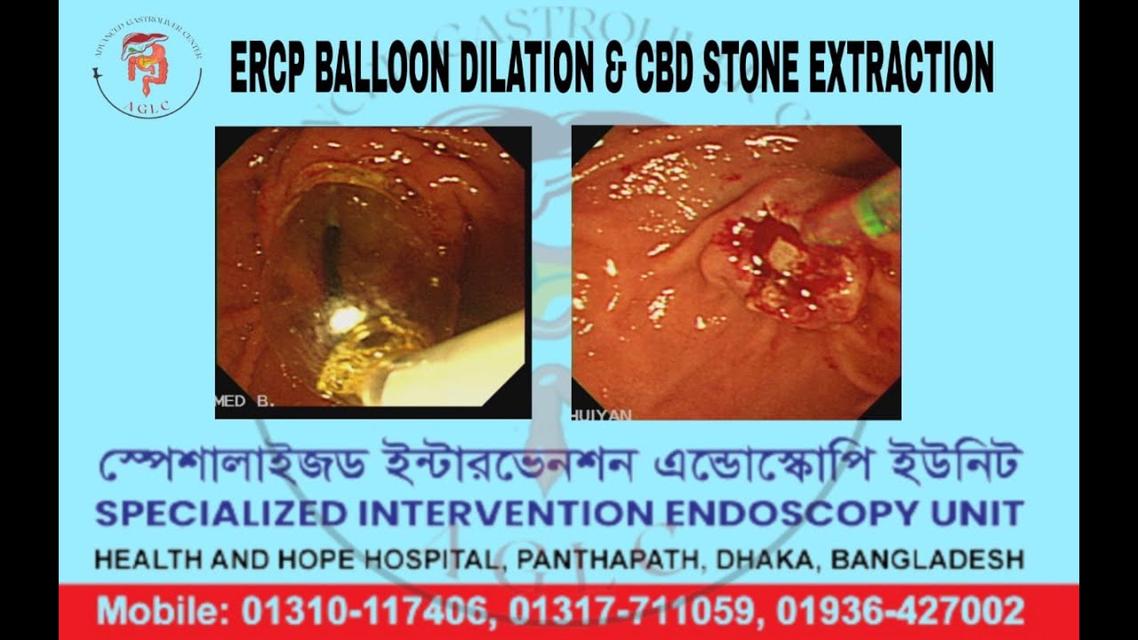 ERCP BALLOON DILATION & STONE EXTRACTION DR MASFIQUE AHMED BHUIYAN,FCPS ...