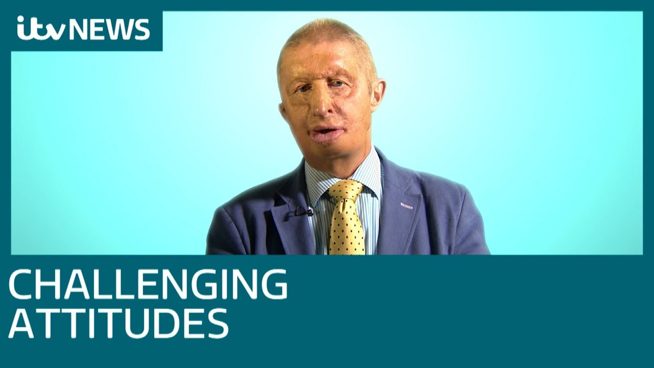 James Partridge: How I'm using my face to challenge attitudes | ITV ...