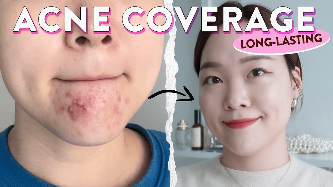 PERFECT LONG-LASTING ACNE COVERAGE TUTORIAL! ☺️ - YouTube