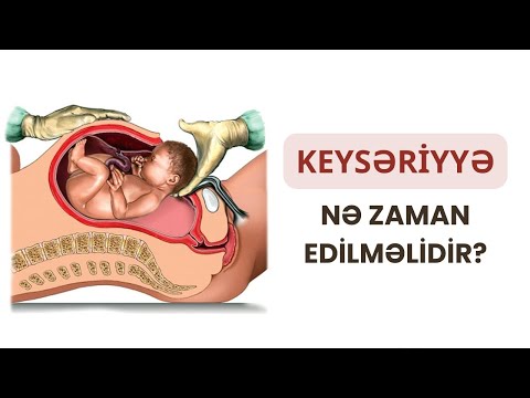 Doğuş başlamışdı, amma təcili kesar qərarı verildi – niyə?