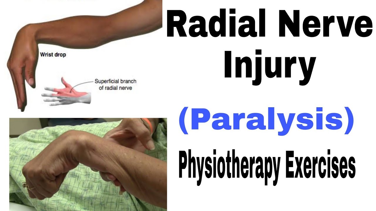 RADIAL NERVE INJURY / Paralysis/ Physiotherapy Treatment @geethamihi ...