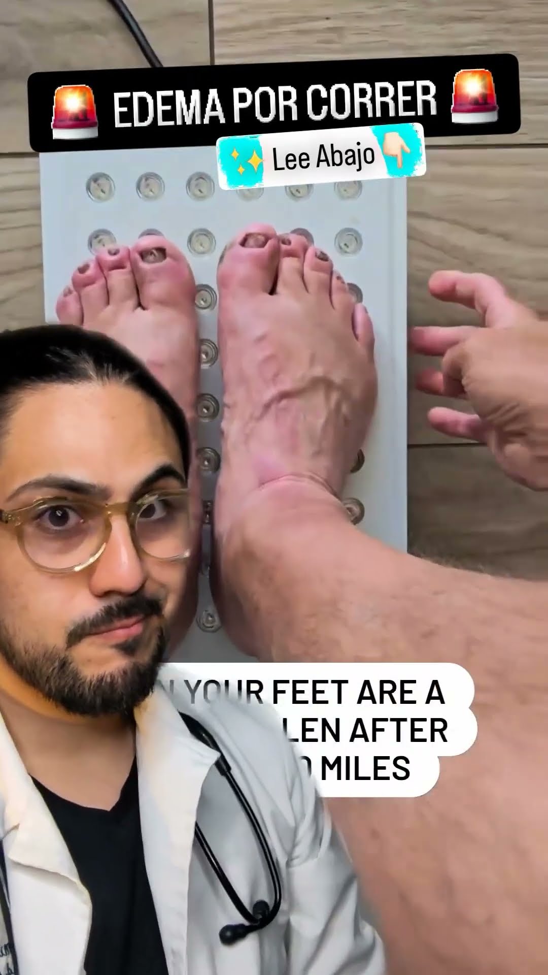 ASÍ SE VE UN EDEMA DE PIE🥺☠️ - YouTube