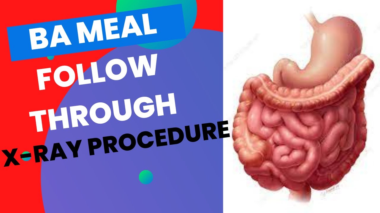 Ba Follow through X-ray Procedure|X-rayBa Meal FollowThrough procedure ...