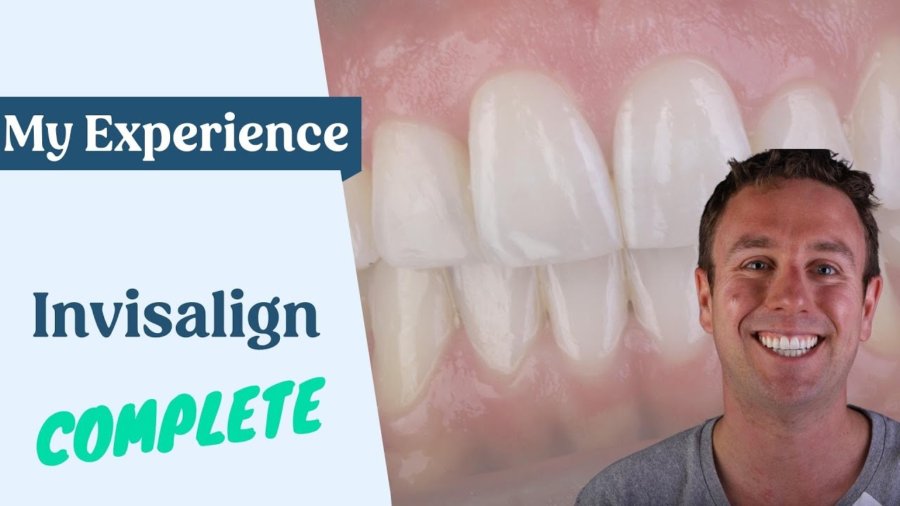 My Invisalign Experience Part 6 - Finally complete! - YouTube