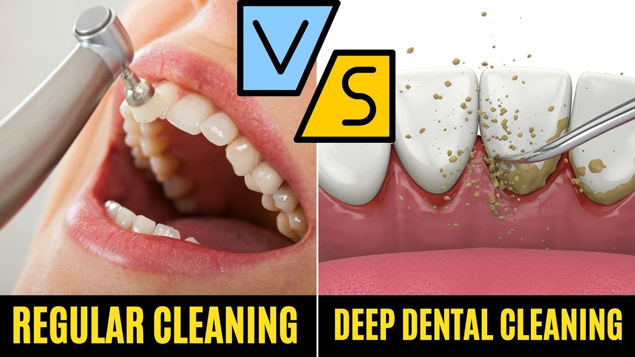 Deep Dental Cleaning vs Regular Cleaning: What's the Difference? - YouTube
