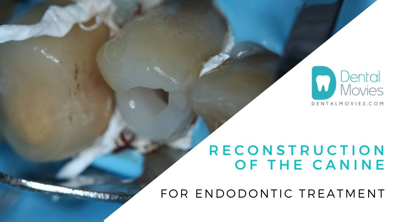 Reconstruction of the canine for endodontic treatment. - YouTube