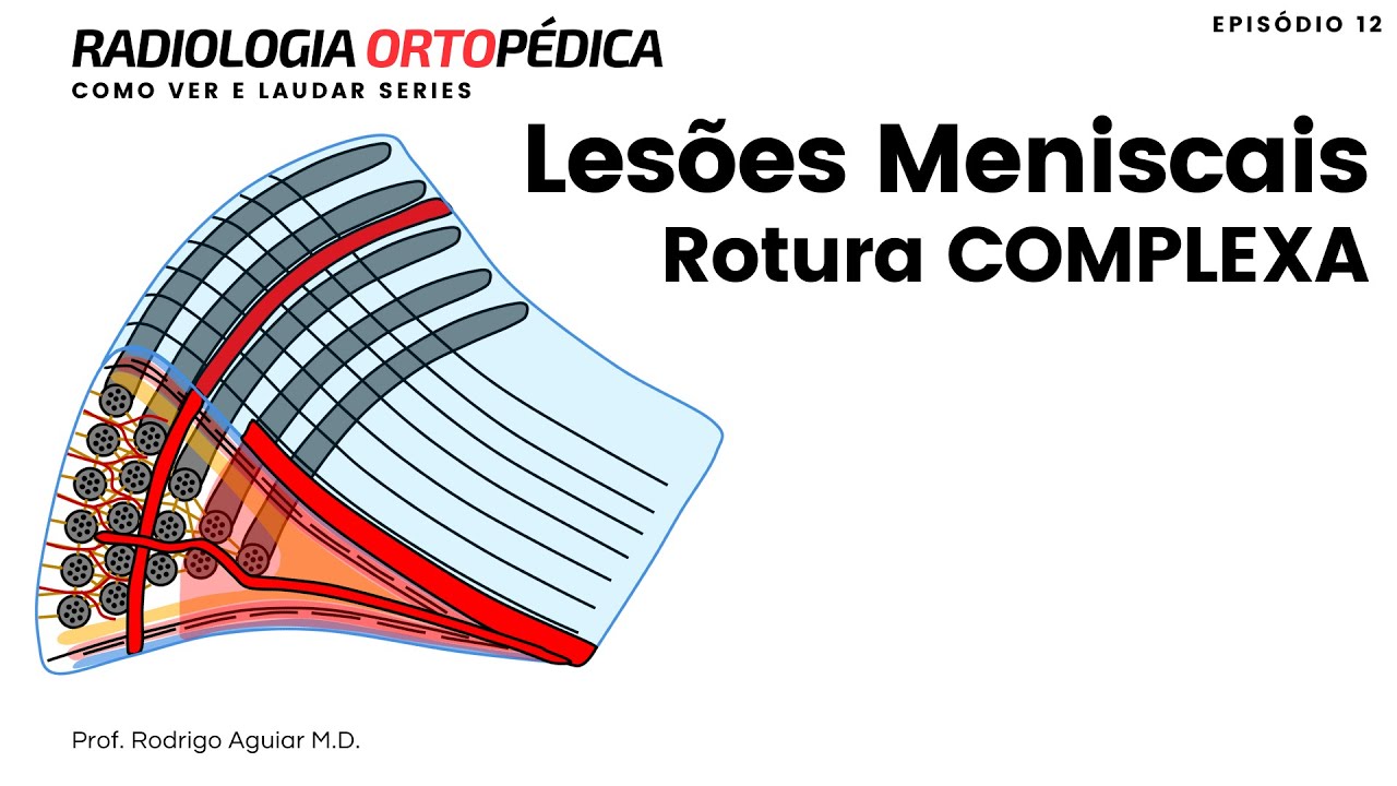 Ruptura Do Menisco Lateral Corno Posterior Rotura Do LCA E Do Menisco