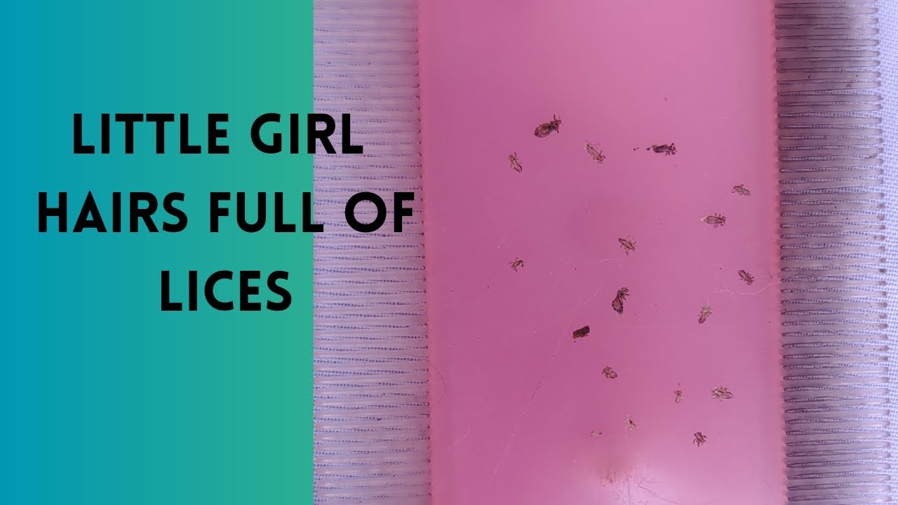 checking nits from little girls hiar - YouTube