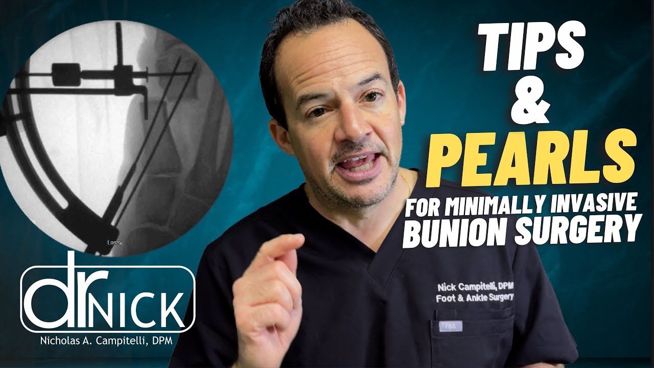 How to Perform Arthrex Minimally Invasive Bunion Surgery | Dr. Nick ...