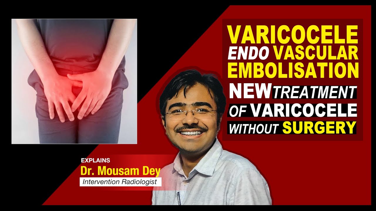 Varicocele Embolization in male infertility | Dr. Mousam Dey ...